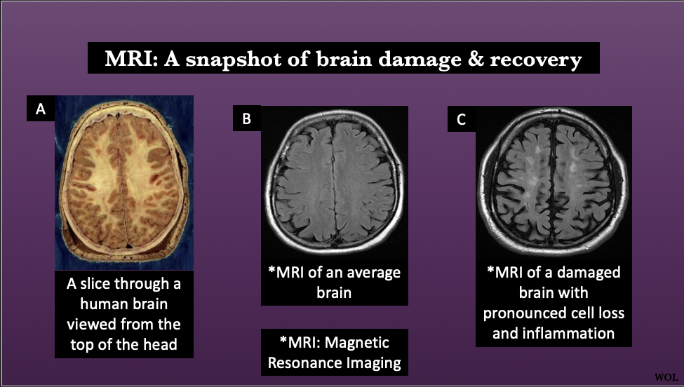 MRI: A snapshot of brain damage and recovery – NeuroGist